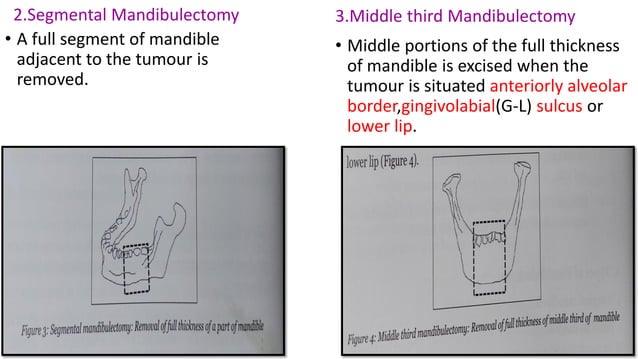 ORAL CAVITY CANCER RESECTIONS:MANDIBULECTOMY & GLOSSECTOMY | PDF