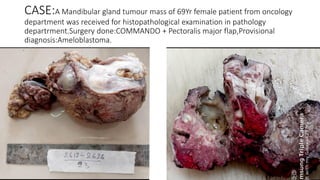 ORAL CAVITY CANCER RESECTIONS:MANDIBULECTOMY & GLOSSECTOMY | PDF
