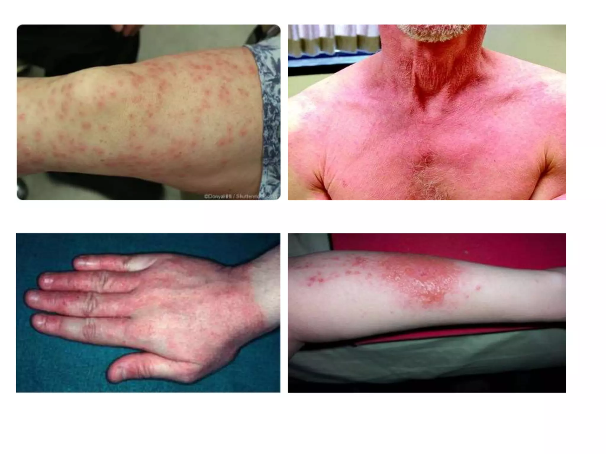 Occupational dermatitis | PPTX