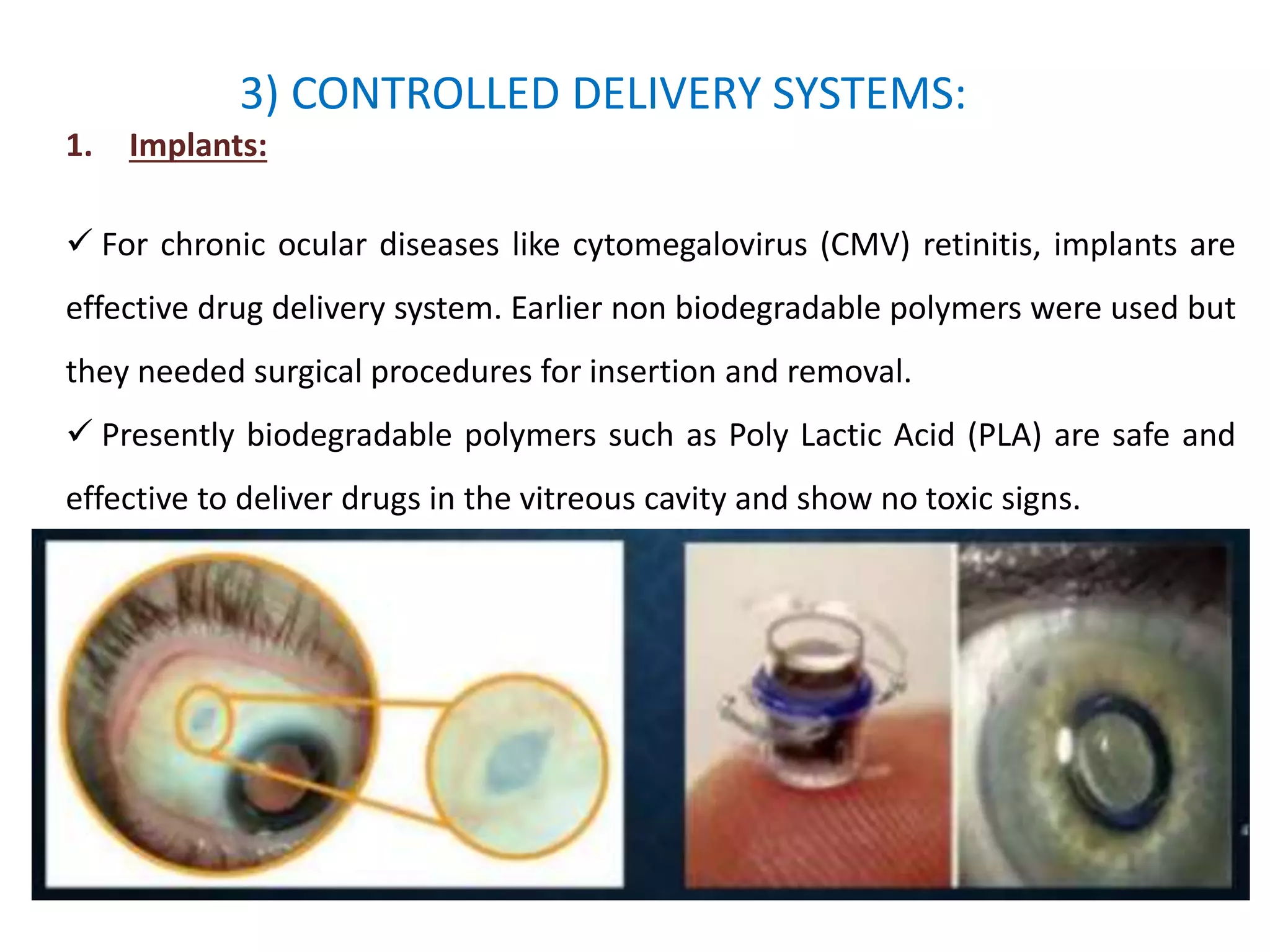 Occular drug delivery systems | PPTX