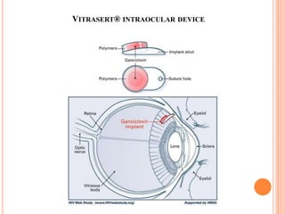Occular drug delivery | PPT