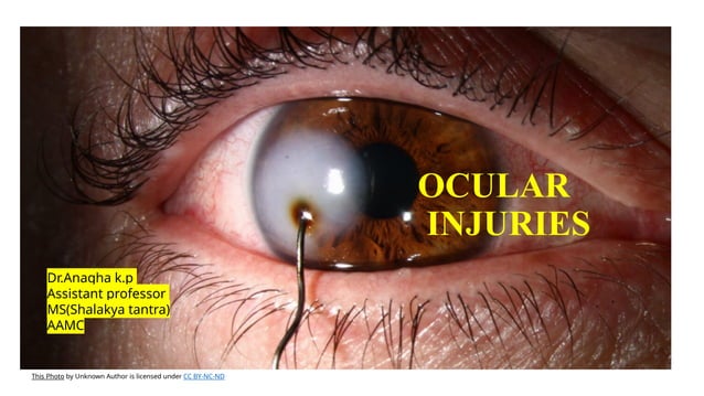 OCCULAR INJURIES ,TYPES AND ITS MANAGEMENT | PPT