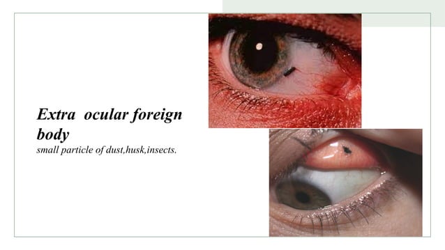OCCULAR INJURIES ,TYPES AND ITS MANAGEMENT | PPT