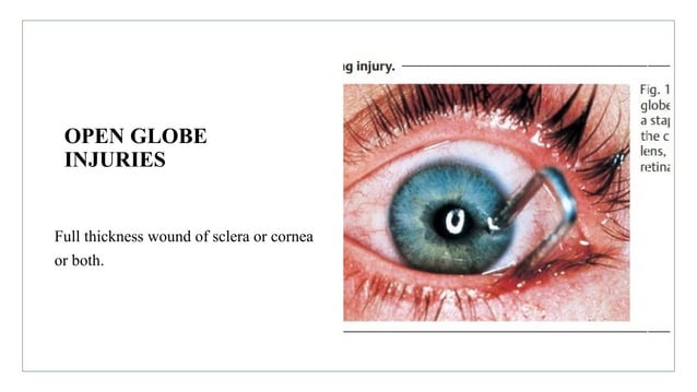 OCCULAR INJURIES ,TYPES AND ITS MANAGEMENT | PPT