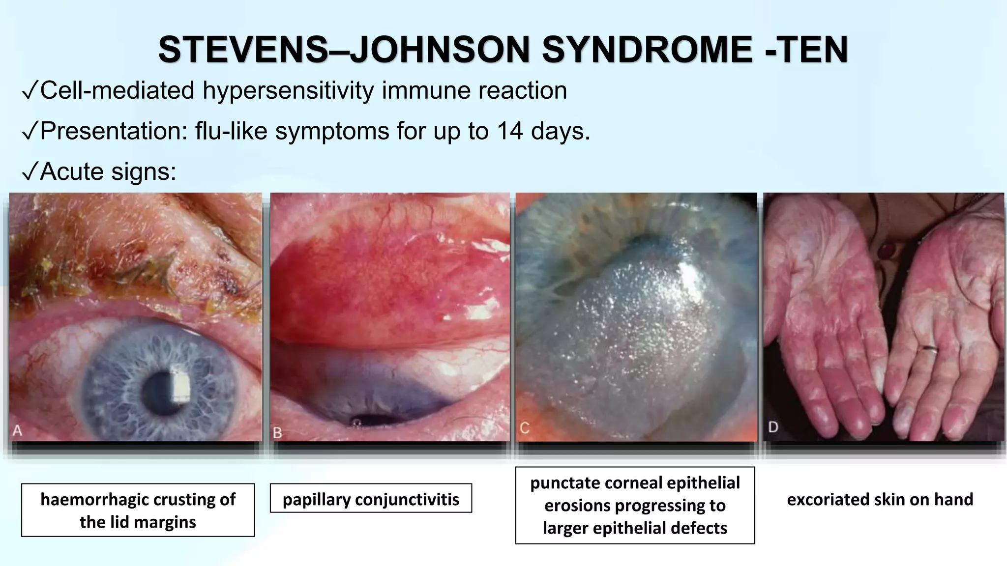 Occular manifestations in HIV AIDS .pptx