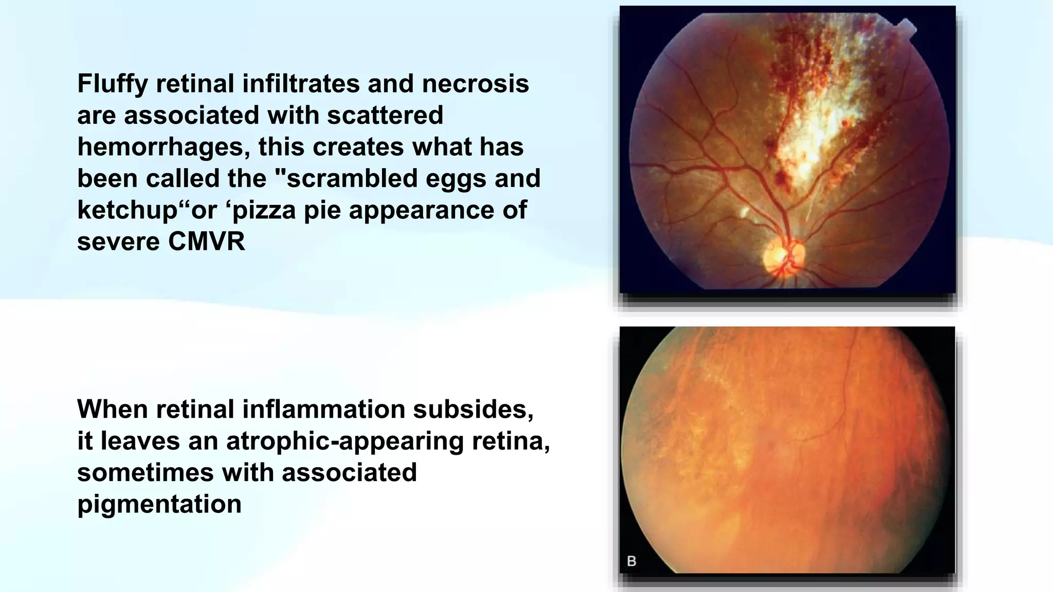 Occular manifestations in HIV AIDS .pptx