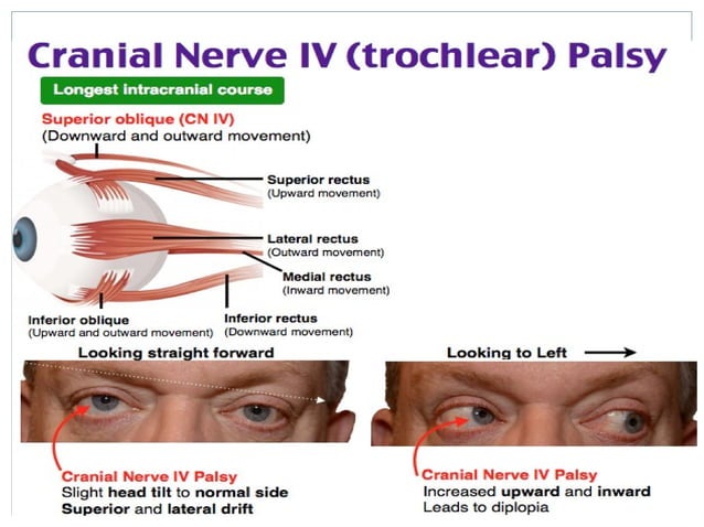 Occulomotor ,Trochlear and Abducens Nerve.pptx