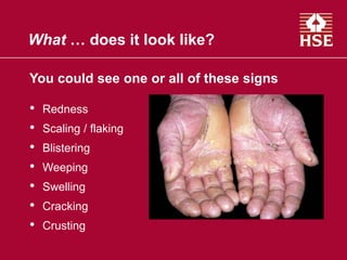 occupational-dermatitis-what.ppt