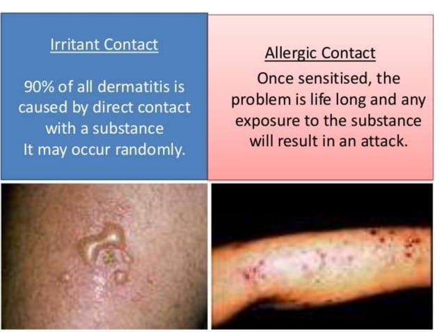 Occupational dermatitis | PPTX | Skin and Dermatology | Diseases and ...