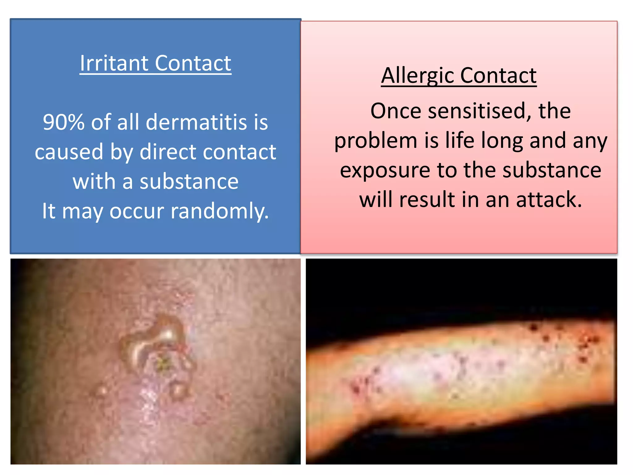 Occupational dermatitis by dr. imtiyaz | PPTX