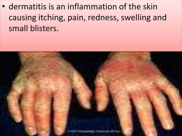 Occupational dermatitis by dr. imtiyaz | PPTX