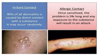 Occupational Dermatitis new ppt in psm.pptx