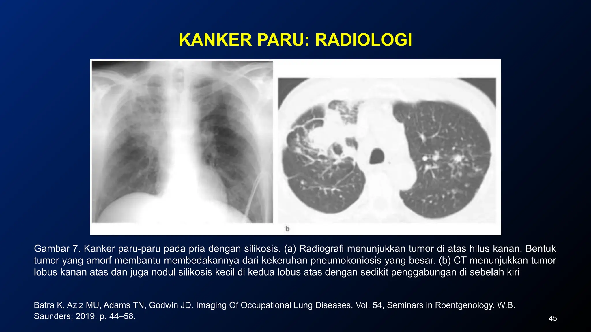 Occupational Lung Disease penyakit paru akibat kerja.pptx