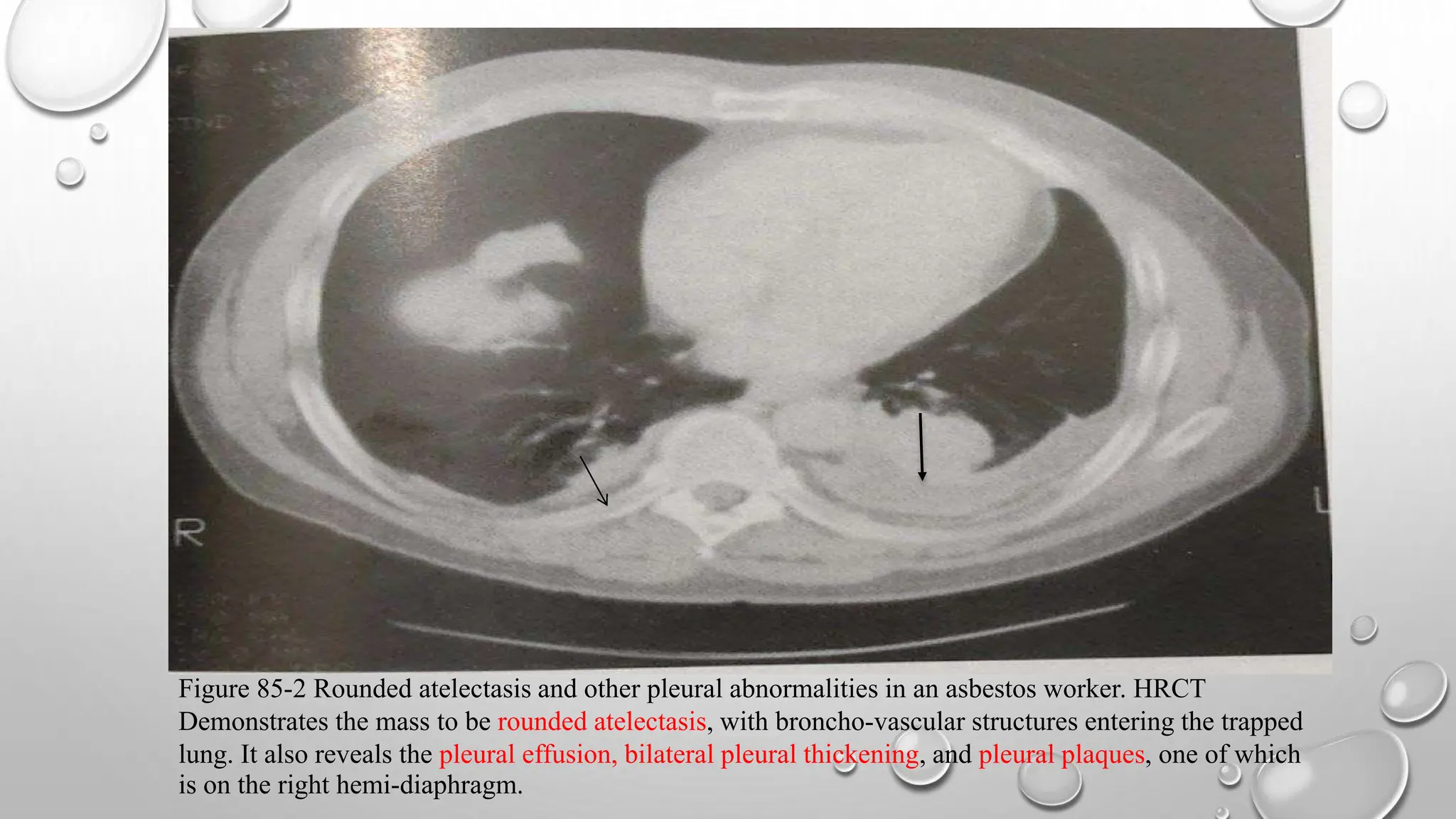 OCCUPATIONAL LUNG DISORDERS by postgraduate students .pptx
