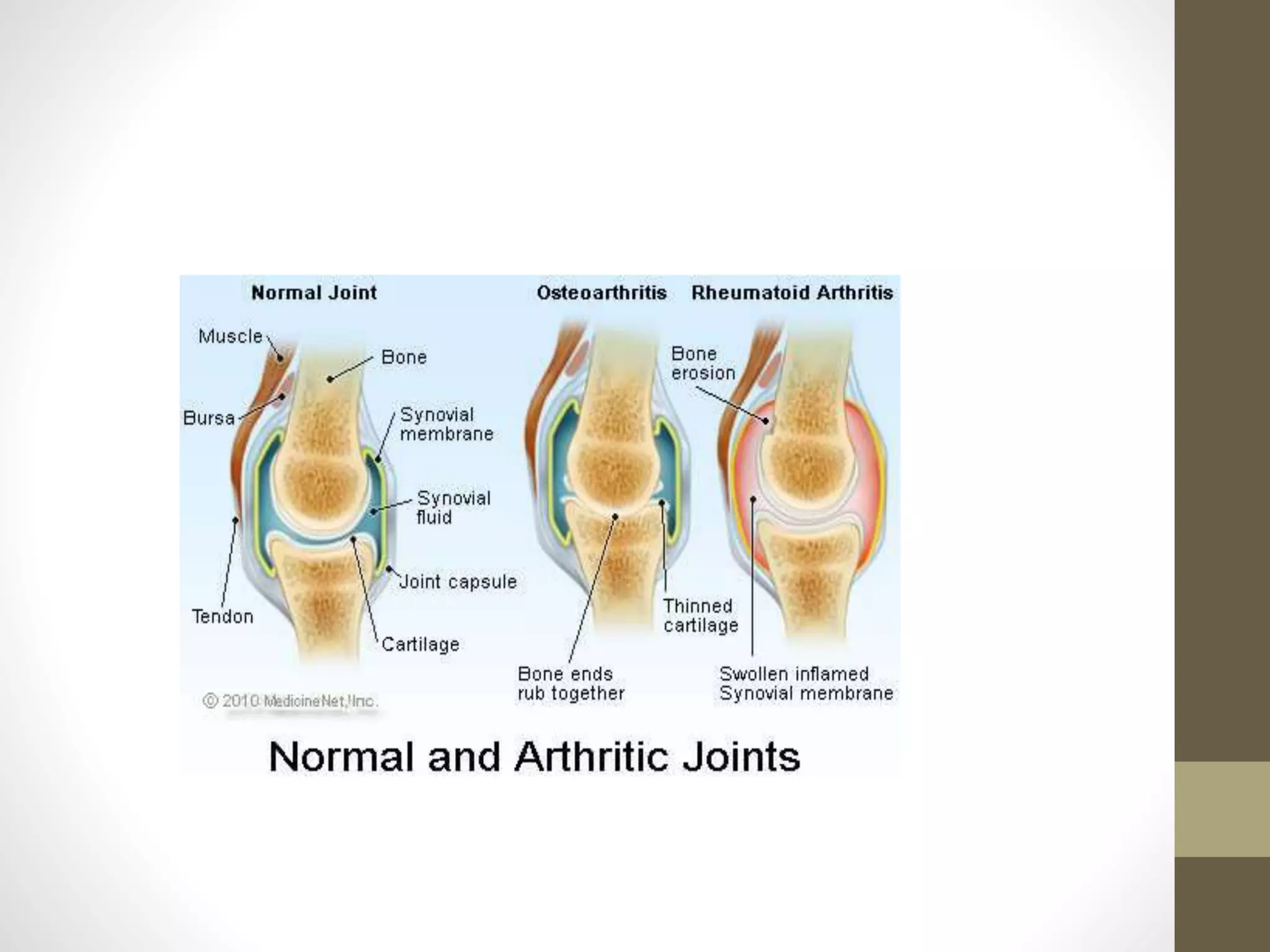 Occupational therapy in rheumatoid arthritis | PPTX