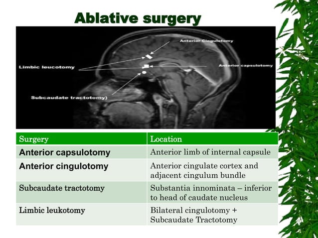 Brain Stimulation Methods In Ocd Ppt