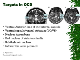 BRAIN STIMULATION METHODS IN OCD | PPTX