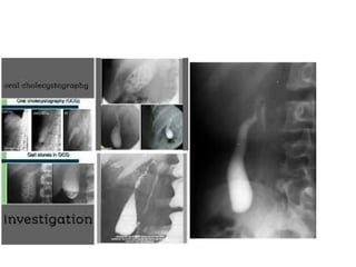 oral cholecystography radiological procedure | PPTX
