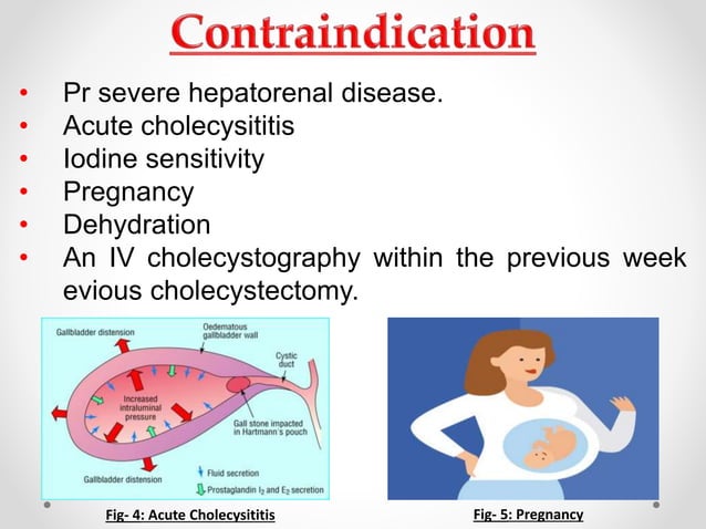 OCG (Oral cholecystogram) BY Akash Das | PPTX | Digestive Disorders ...