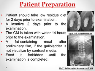 OCG (Oral cholecystogram) BY Akash Das | PPTX
