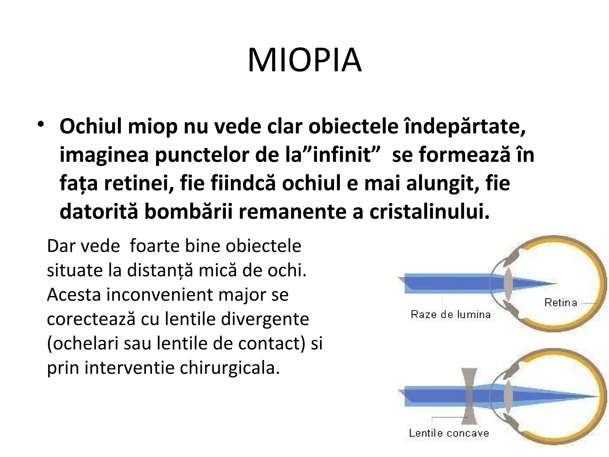 Ochiul. defecte de vedere | PPT