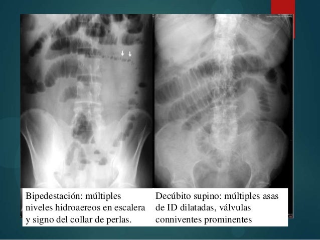 Oclusión intestinal