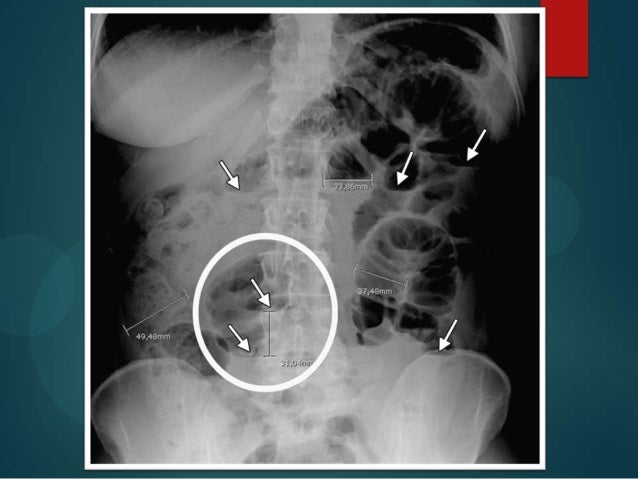 Oclusión intestinal
