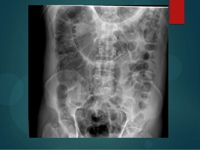 Oclusión intestinal
