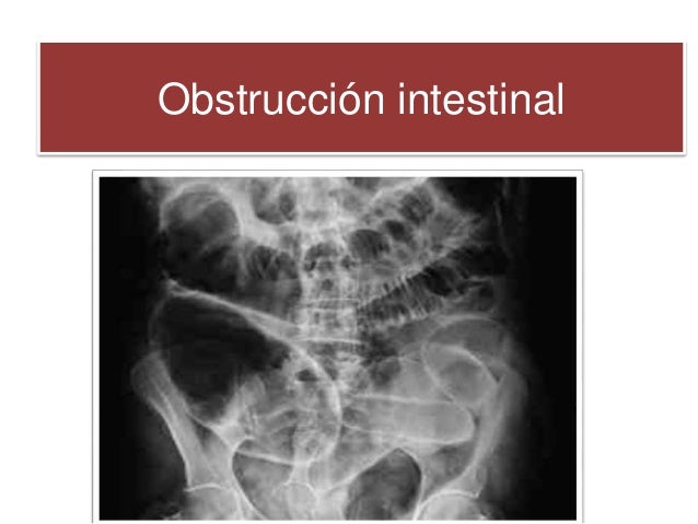 Oclusión intestinal.