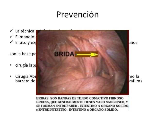 Oclusión intestinal.