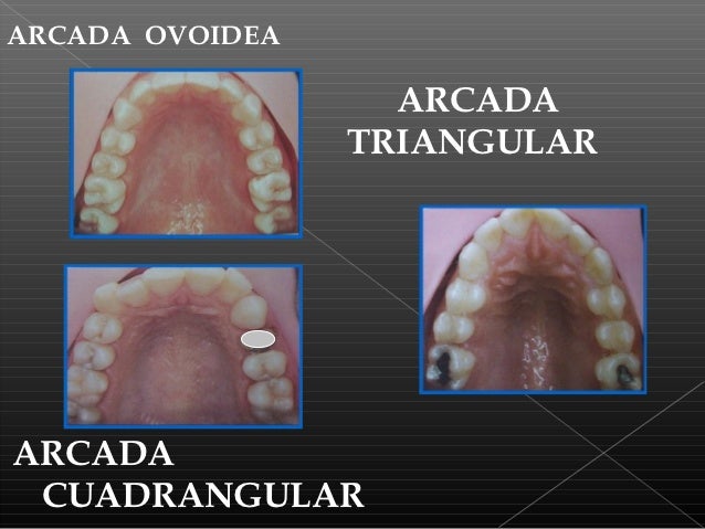 Oclusion dental
