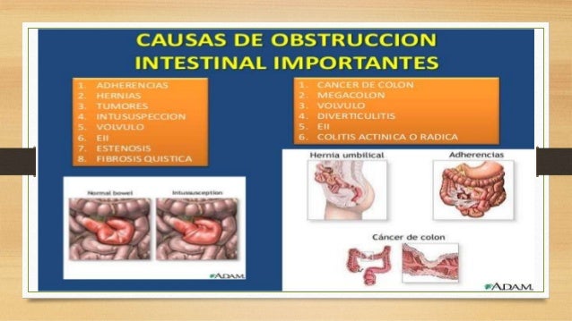 Oclusion intestinal