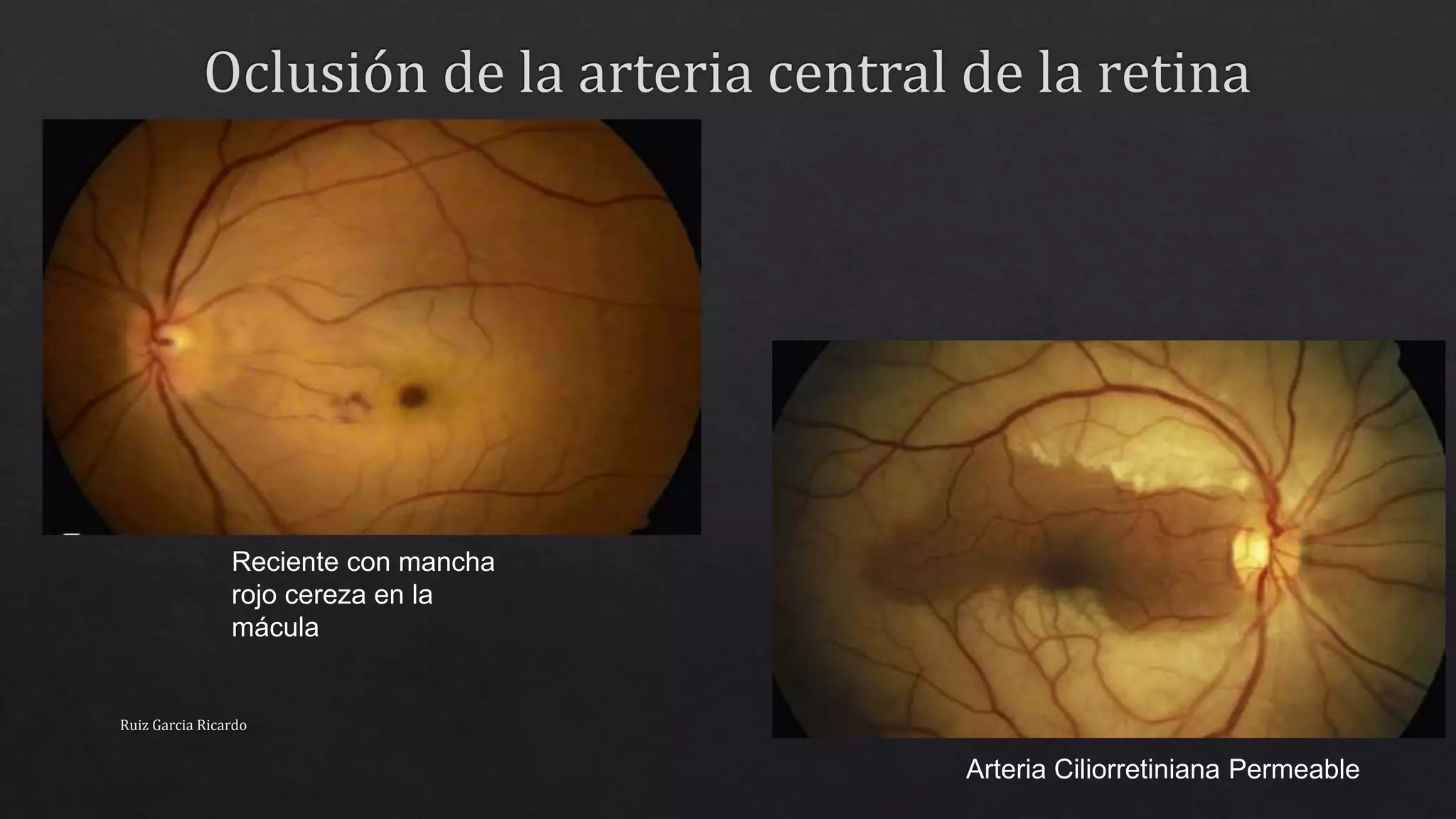 Oclusiones arteriales retinianas