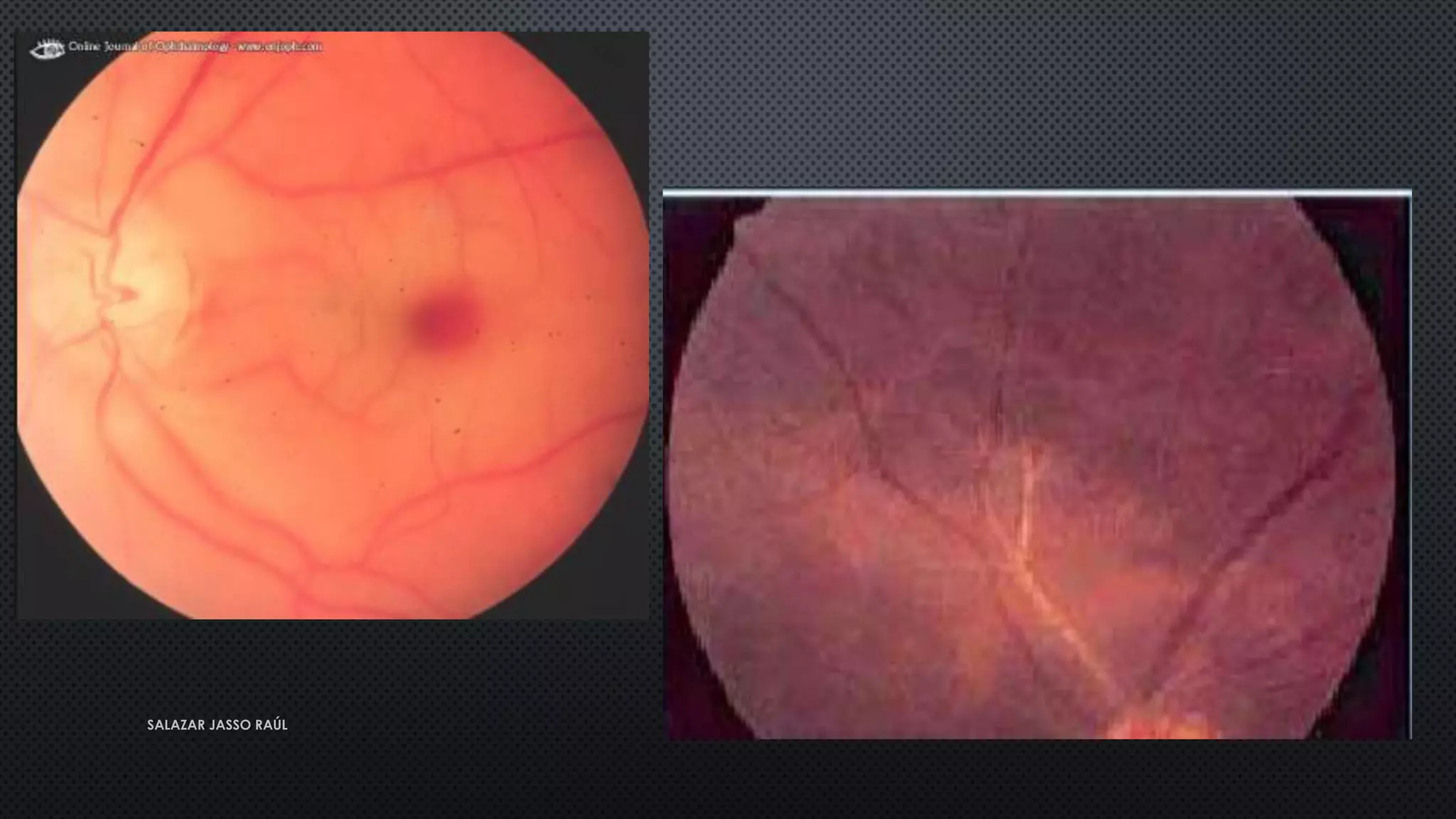 Oclusiones vasculares de la retina | PPT