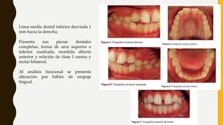 Oclusión I -Mordida abierta | PPTX