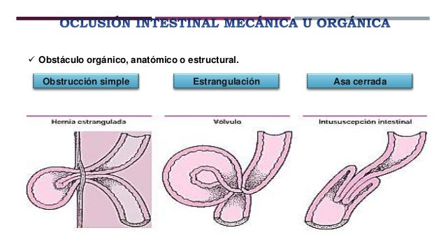 Oclusion intestinal cirugia