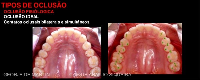 Oclusão dentária protec 2013