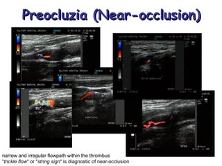 Occlusion and near occlusion of carotid arteries | PPT