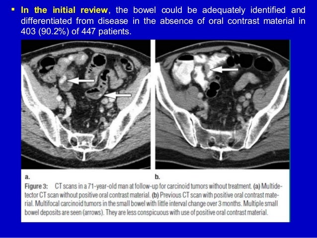 Positive Oral Contrast for Oncology Patients