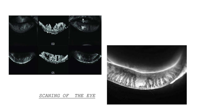 OCULAR ROSACEA: Introduction, symptoms and causes, Diagnosis ...