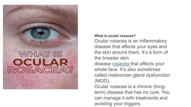 OCULAR ROSACEA: Introduction, symptoms and causes, Diagnosis ...