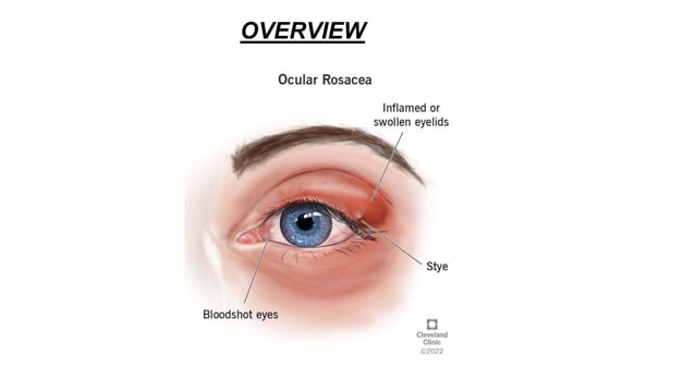 OCULAR ROSACEA: Introduction, symptoms and causes, Diagnosis ...