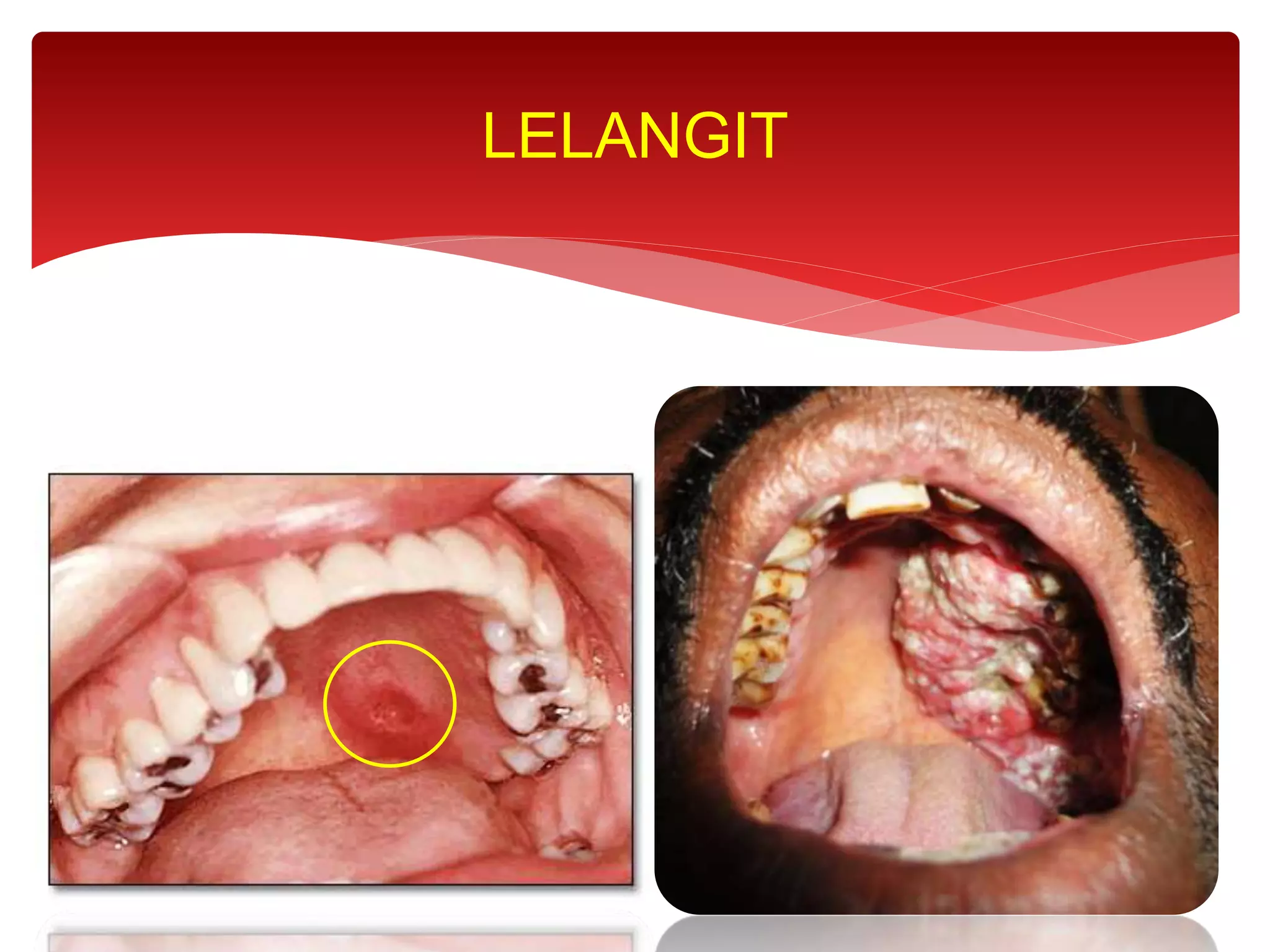 Kanser Mulut/Oral | PPTX