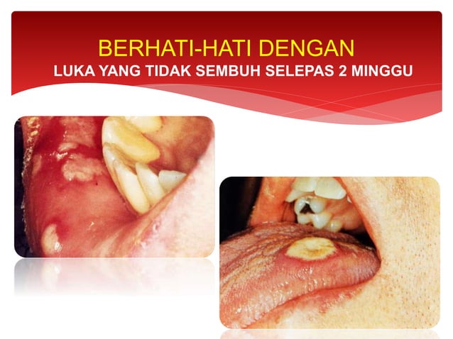 Kanser Mulut/Oral | PPTX