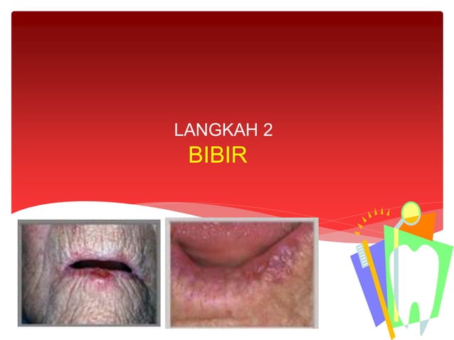 Kanser Mulut/Oral | PPTX