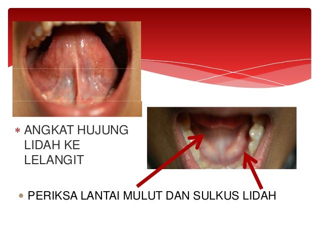 Kanser Mulut/Oral