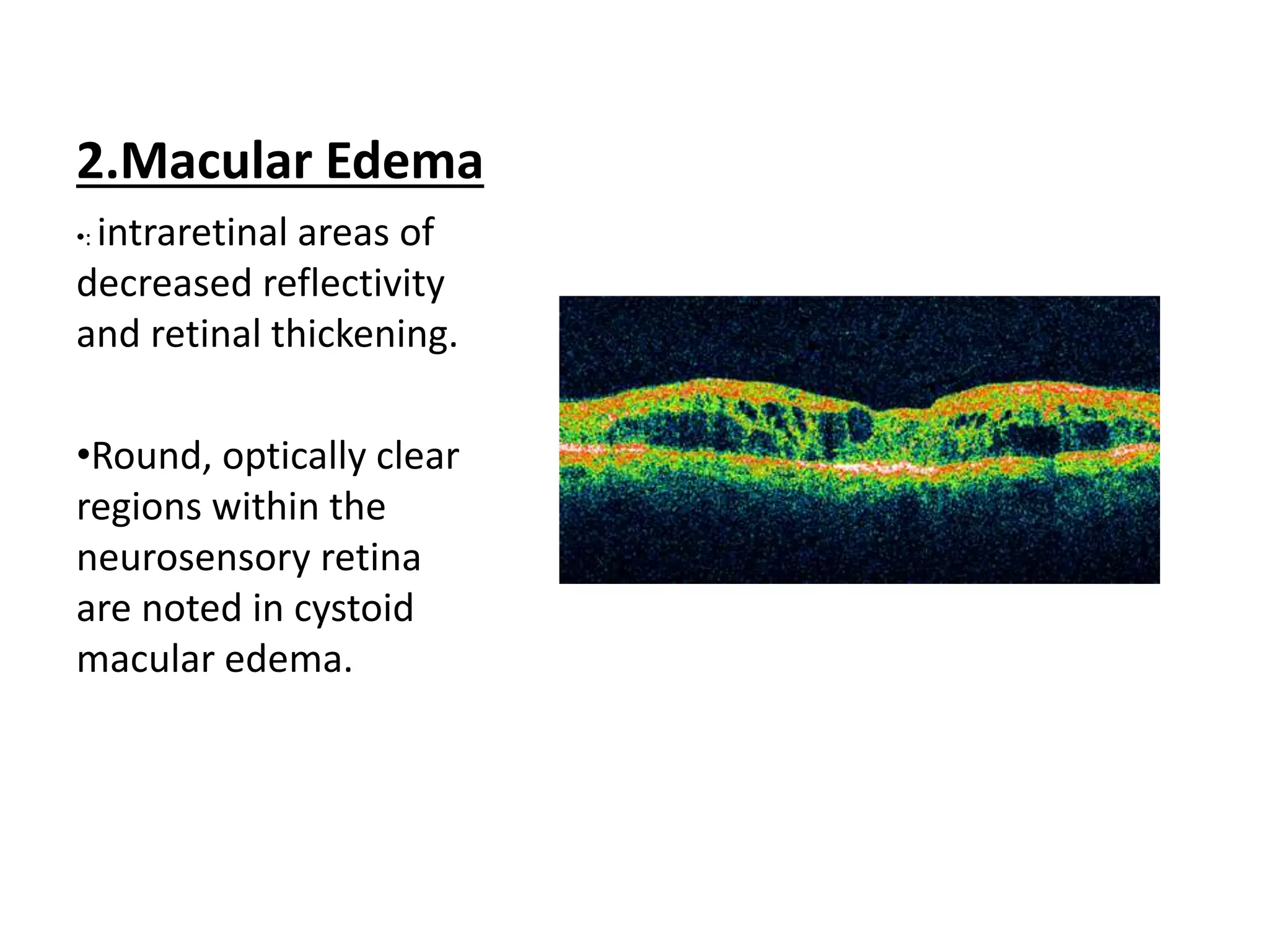 Optical coherence tomography | PPTX