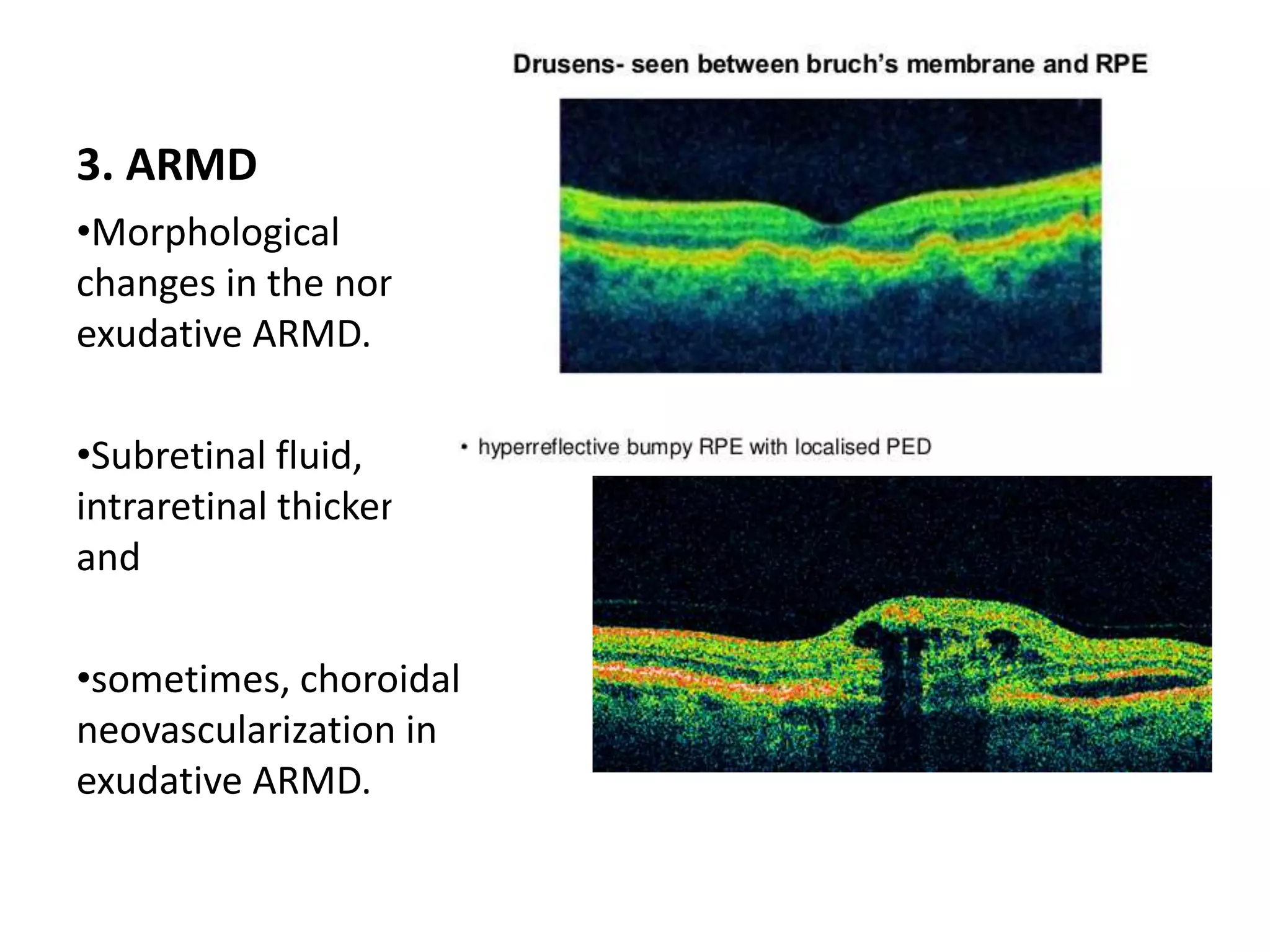 Optical coherence tomography | PPTX
