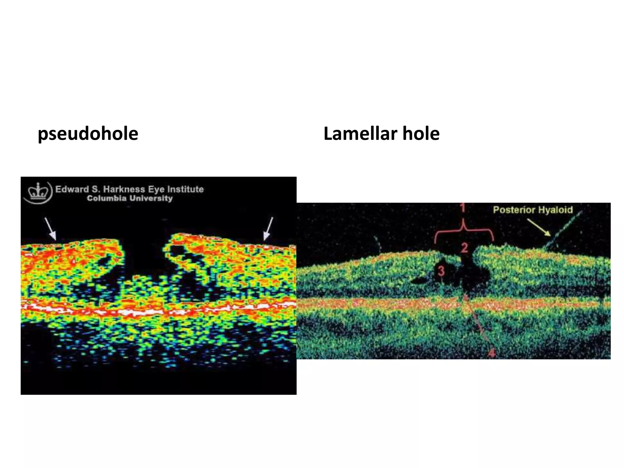 Optical coherence tomography | PPTX