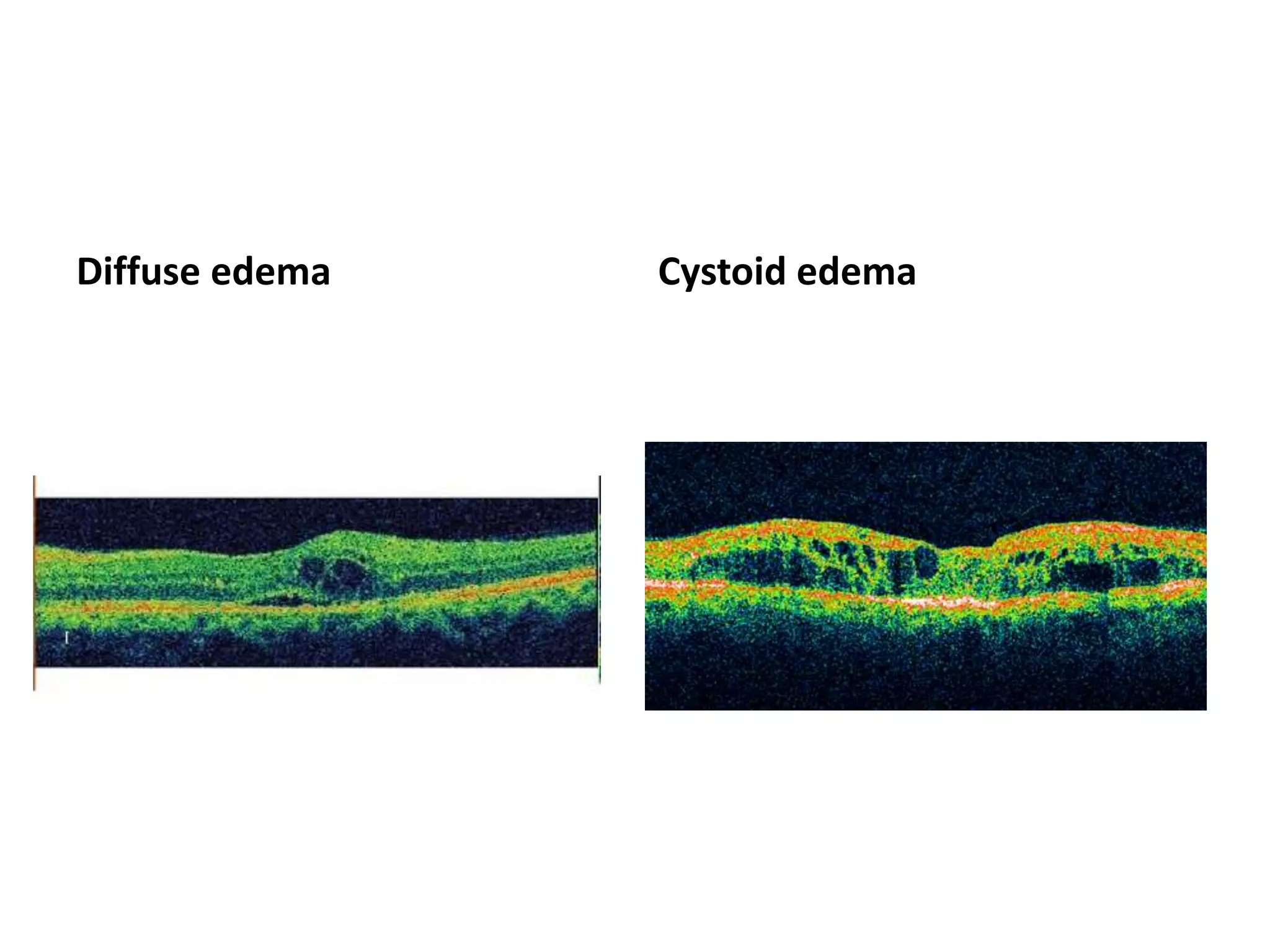 Optical coherence tomography | PPTX